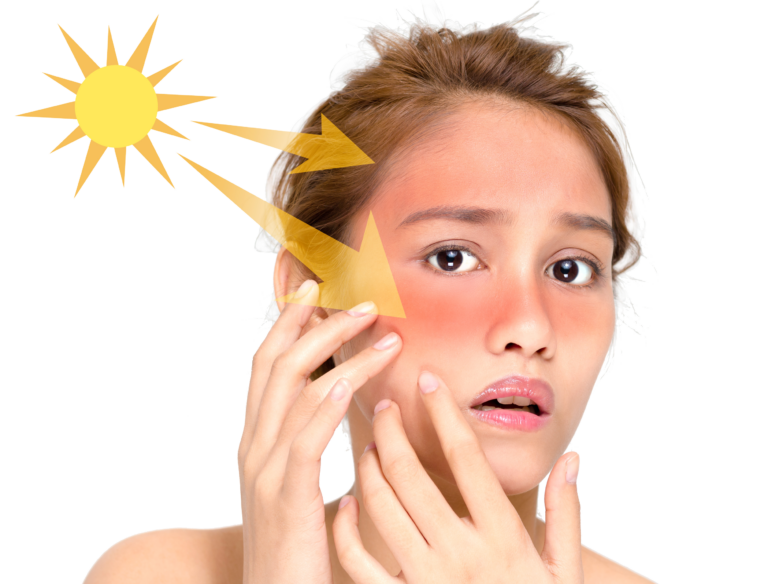 The primary cause of premature ageing of the skin is the Sun